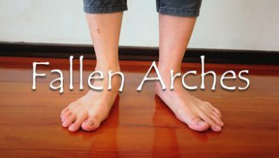 COLLAPSED ARCHES OR FEET? - barefeetpodiatry